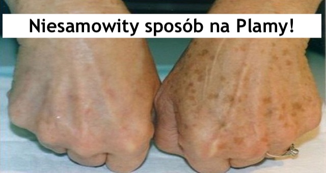 Usunęła swoje brązowe plamy z tym powszechnym składnikiem. Niesamowity ...